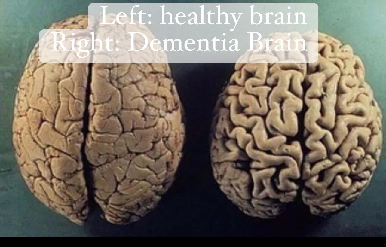 Insight: What is the difference between dementia and Alzheimer’s ...